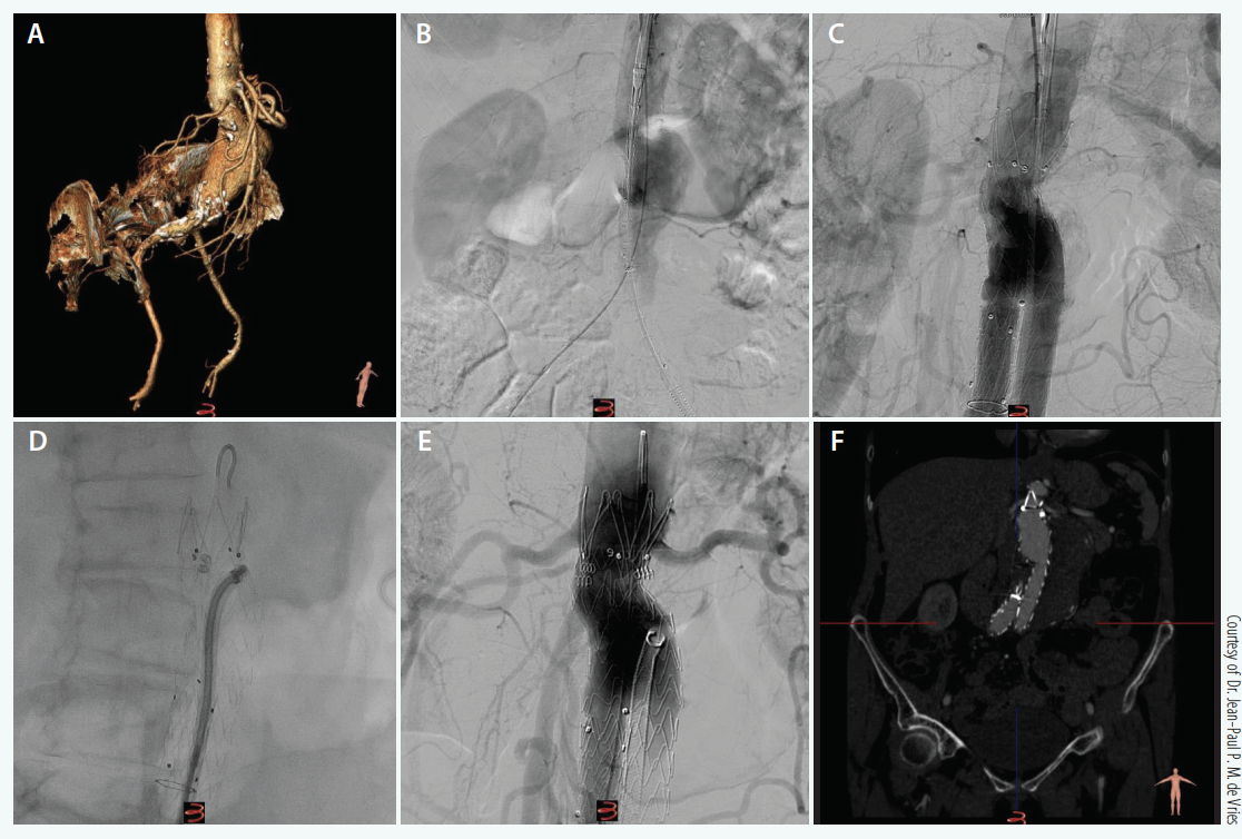 EndoAnchors: Endovascular Stitching During EVAR and TEVAR ...