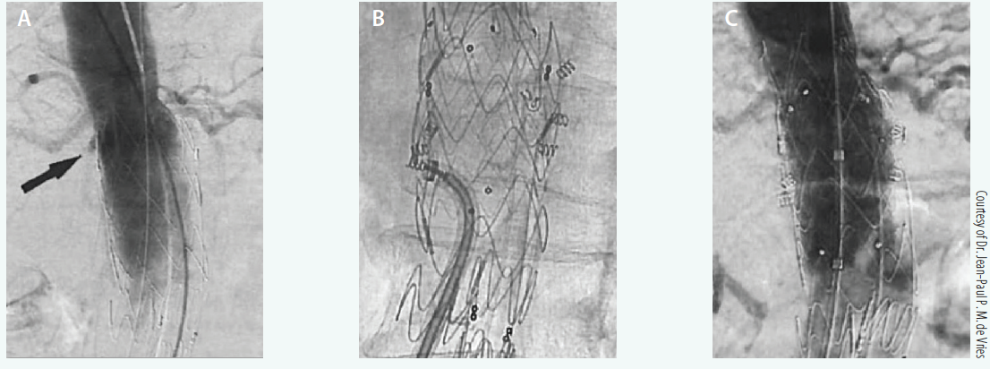 EndoAnchors: Endovascular Stitching During EVAR and TEVAR ...