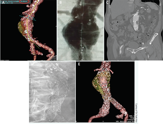Considerations Beyond Anatomy to Best Manage Aortic Disease: The ...