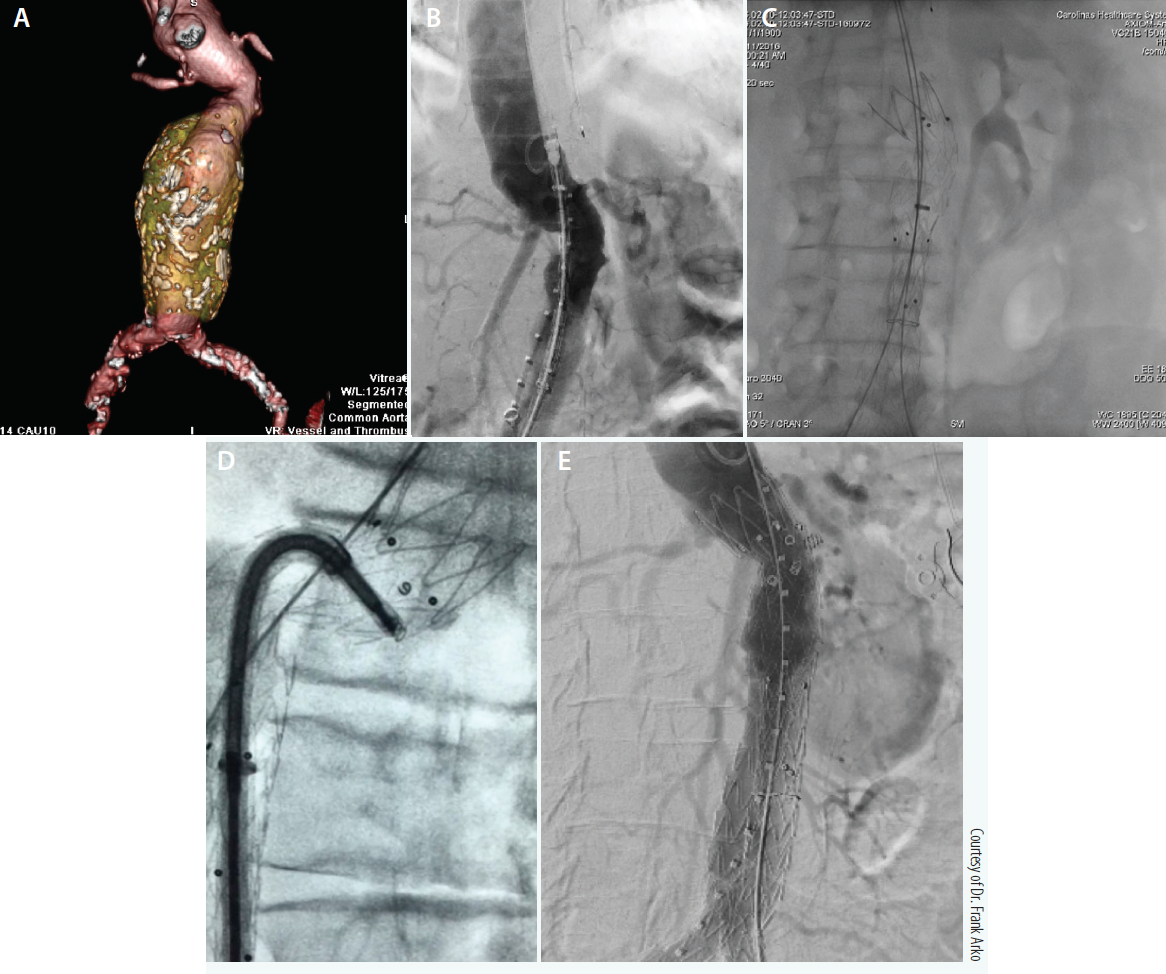 Considerations Beyond Anatomy to Best Manage Aortic Disease: The ...