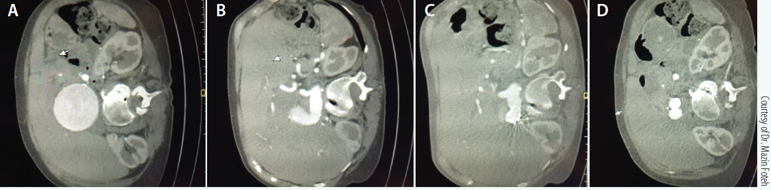 EndoAnchors Advance Treatment of Aortic Aneurysms: Experience in a ...