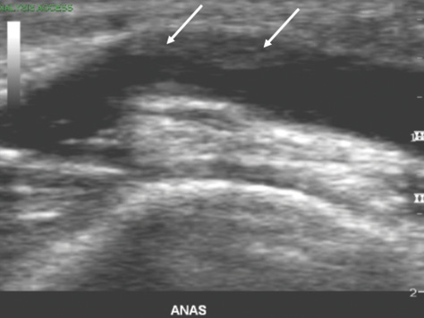 Pathophysiology of Stenosis Within AV Fistulas and Mechanisms of PTA ...