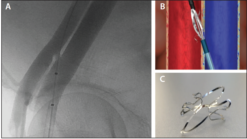 Current Considerations in Venous Obstruction and Stenting ...