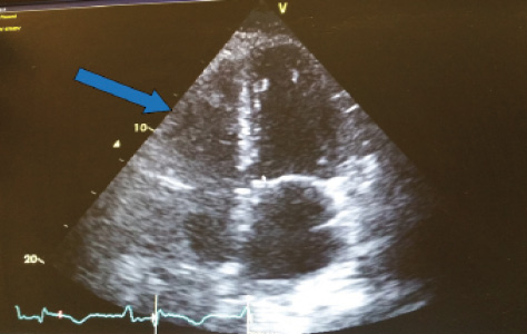 EkoSonic Endovascular System and RP Impella Support Acute Right ...