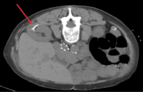 Applications for the MVP™ Microvascular Plug - Endovascular Today