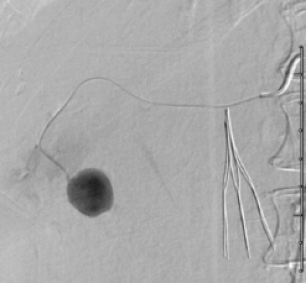 Applications for the MVP™ Microvascular Plug - Endovascular Today