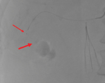 Applications for the MVP™ Microvascular Plug - Endovascular Today