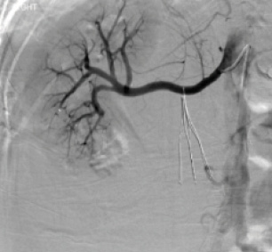 Applications for the MVP™ Microvascular Plug - Endovascular Today