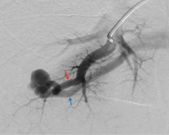 Applications for the MVP™ Microvascular Plug - Endovascular Today