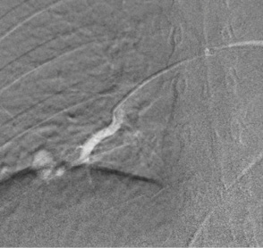 Applications for the MVP™ Microvascular Plug - Endovascular Today