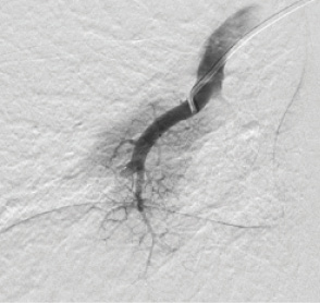 Applications for the MVP™ Microvascular Plug - Endovascular Today