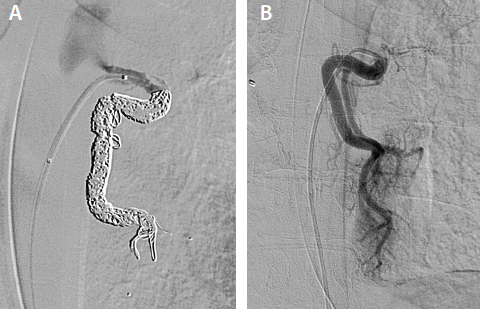 Applications for the MVP™ Microvascular Plug - Endovascular Today