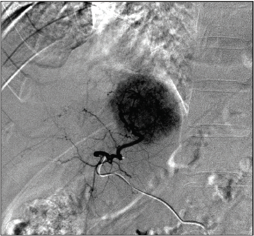 Embozene™ Microspheres for Treatment of Fibronodular Hyperplasia ...