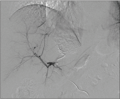 Embozene™ Microspheres for Treatment of Fibronodular Hyperplasia ...