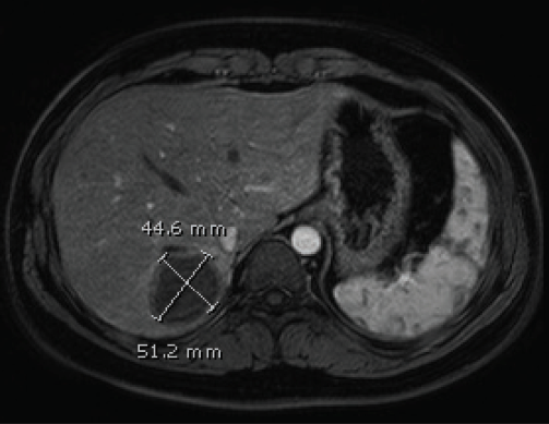 Embozene™ Microspheres for Treatment of Fibronodular Hyperplasia ...