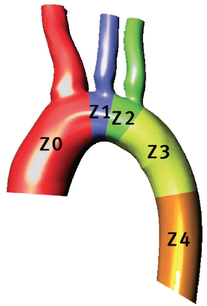Ask the Experts: If a Complicated Type B Dissection Presents With ...