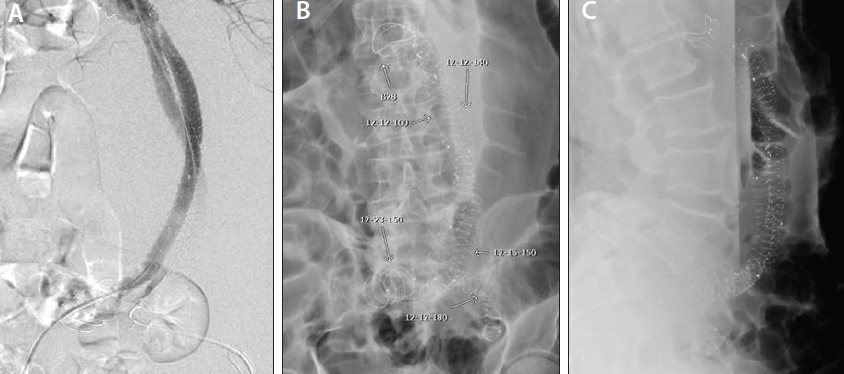 Anaconda™ AAA Stent Graft System for Challenging AAA Anatomy ...