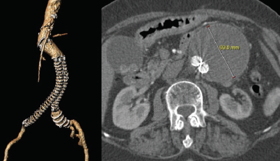 Anaconda™ AAA Stent Graft System for Infrarenal Neck Angulations Up to ...