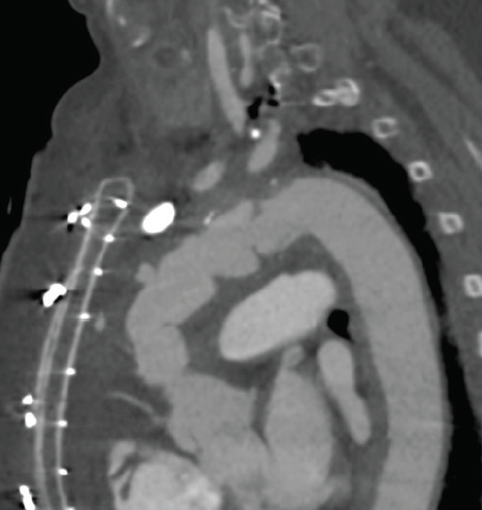 Dual-Sheath Delivery System for Vessel Stabilization Using the Bolton ...