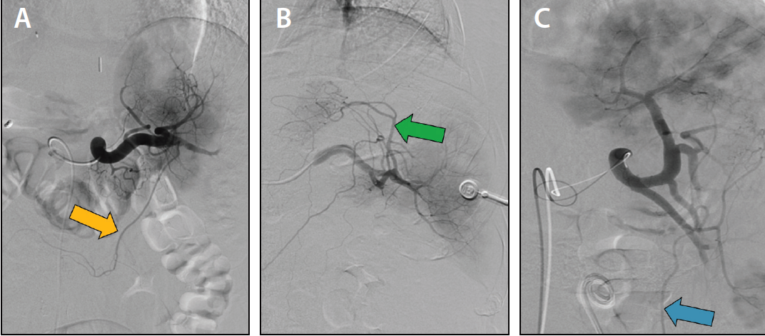 Minimally Invasive Interventions for Nontraumatic Splenic Disorders ...