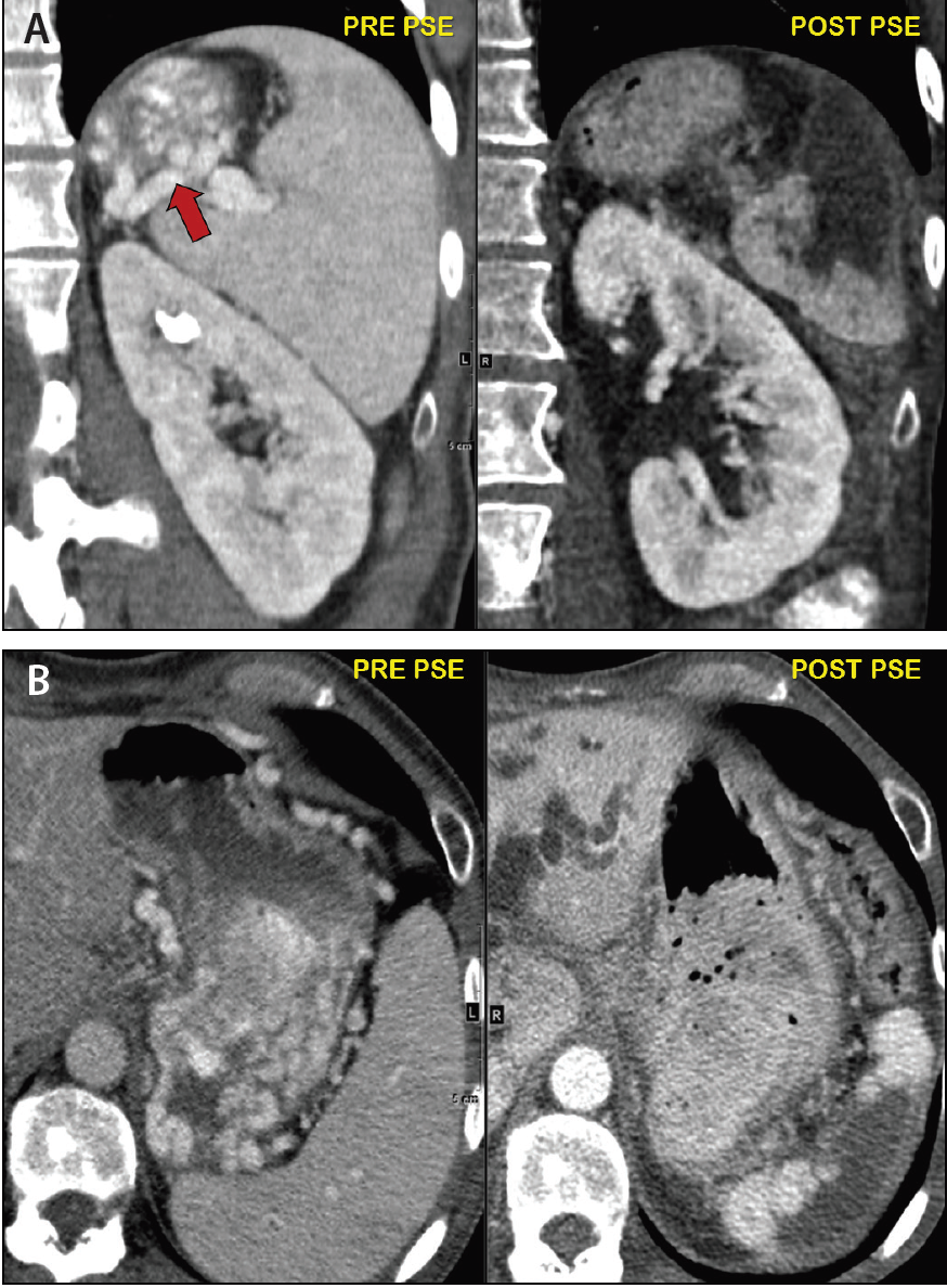 Minimally Invasive Interventions for Nontraumatic Splenic Disorders ...