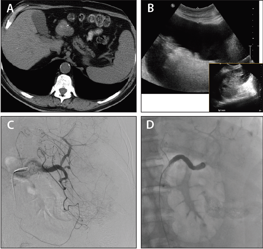 Minimally Invasive Interventions for Nontraumatic Splenic Disorders ...