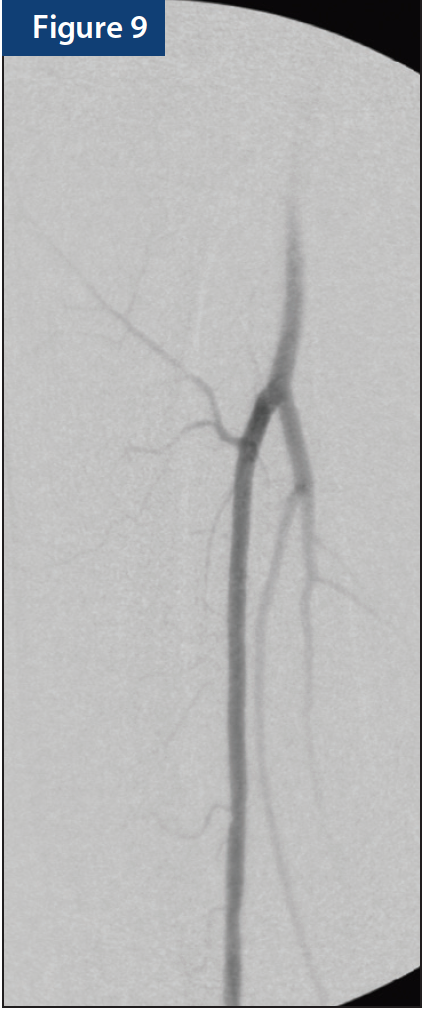 Treating CLI in Calcified, Tortuous Below-the-Knee Anatomy With the ...