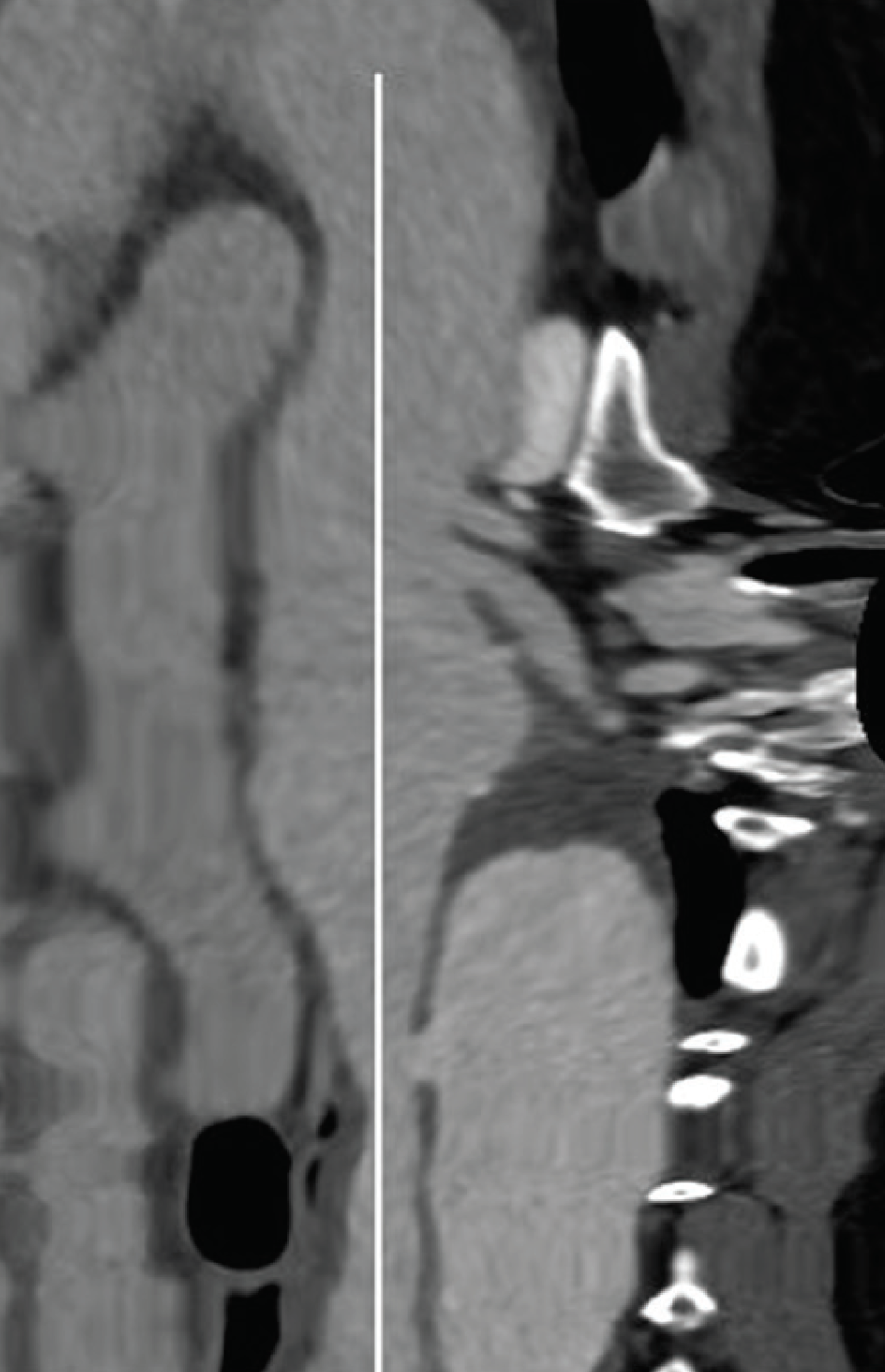 Evolving Endovascular Treatment of Type B Dissection - Endovascular Today