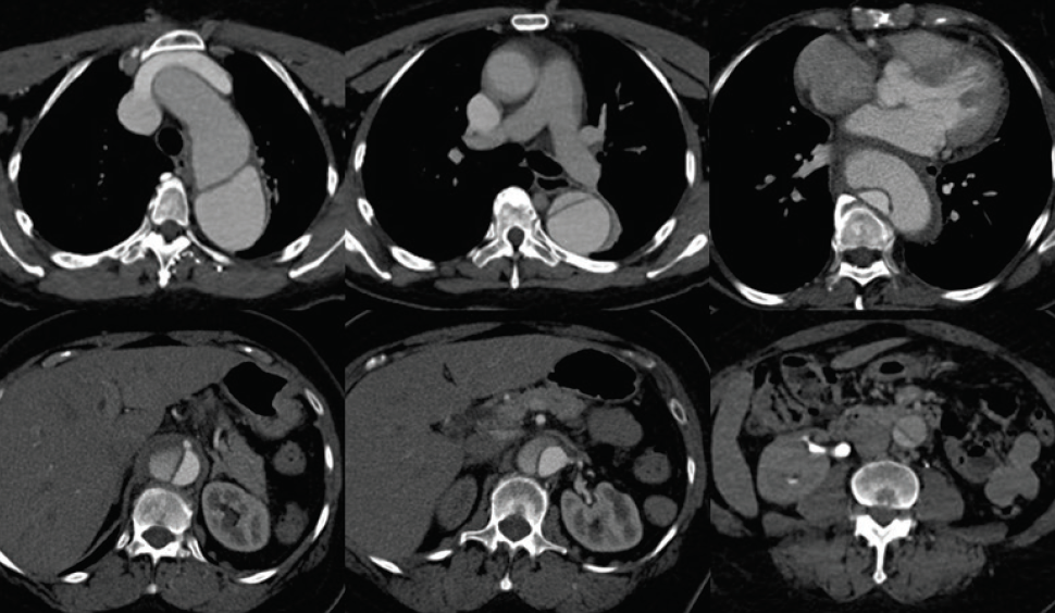 Evolving Endovascular Treatment of Type B Dissection - Endovascular Today