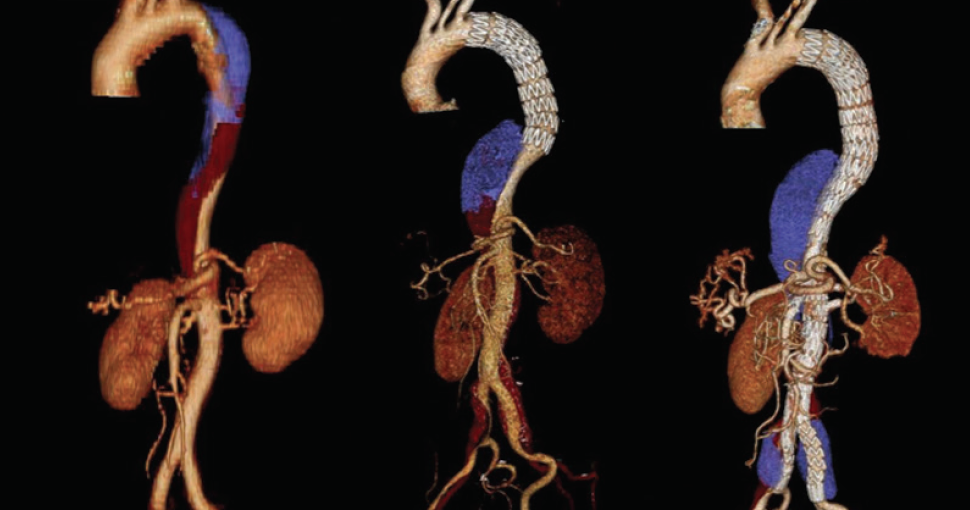 Evolving Endovascular Treatment of Type B Dissection - Endovascular Today