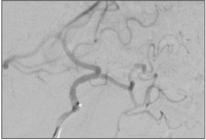Bariatric Embolization for Obesity: A New Frontier for Interventional ...