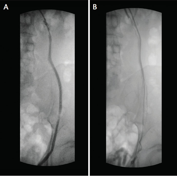 Varicocele Embolization for Infertility - Endovascular Today