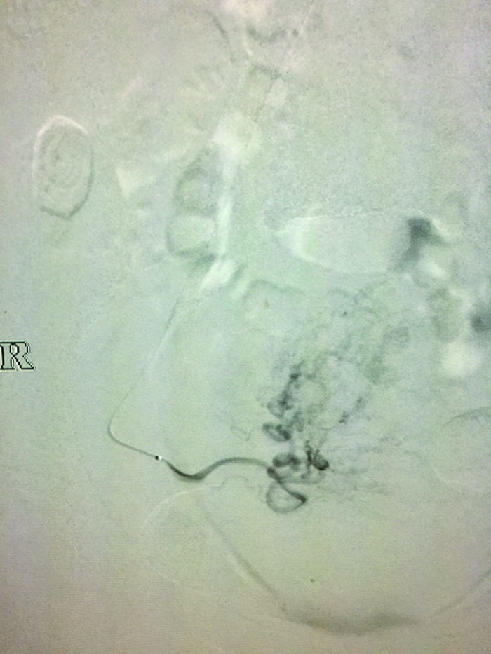 Treatment of Pedunculated Fibroid With Embozene™ - Endovascular Today