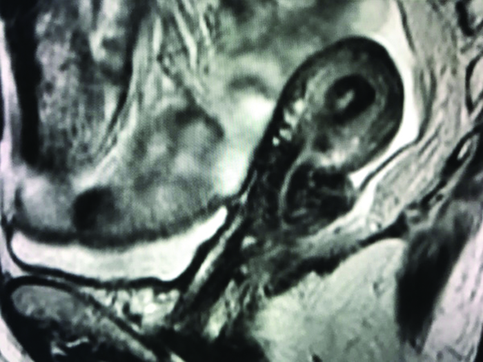 Treatment of Pedunculated Fibroid With Embozene™ - Endovascular Today