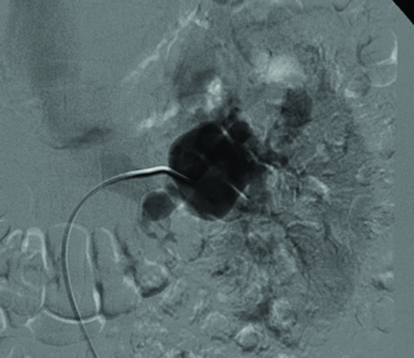 Embolization of a Renal Artery Arteriovenous Malformation Using ...