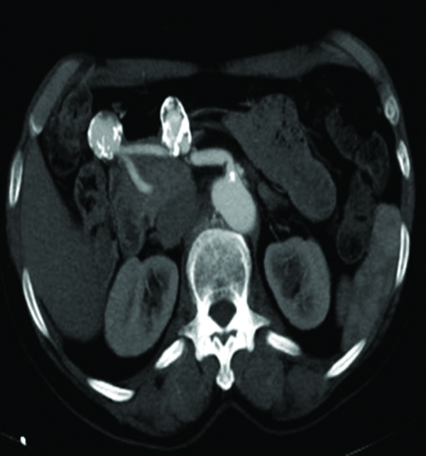 Embolization of Inferior Pancreaticoduodenal Artery Aneurysms Using the ...