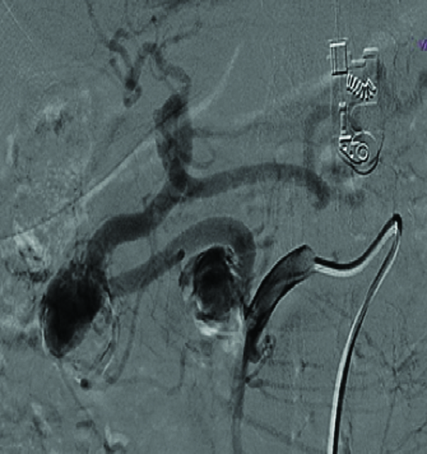 Embolization of Inferior Pancreaticoduodenal Artery Aneurysms Using the ...