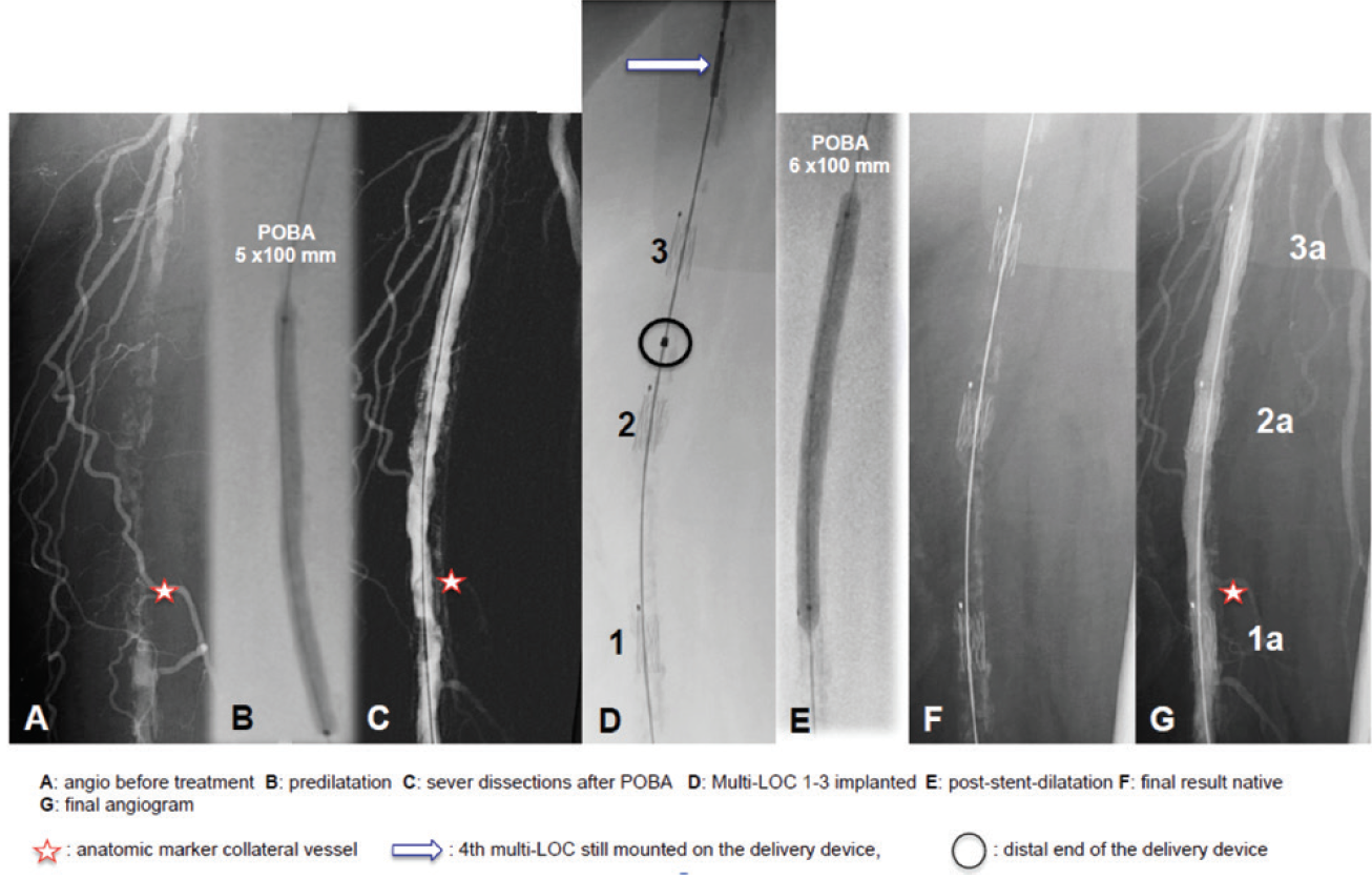 VascuFlex® Multi-LOC: Spot Stenting With SeQuent® Please OTW DCB ...