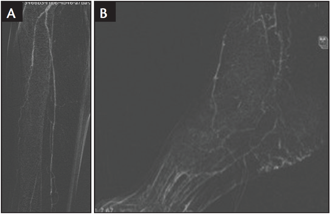 CO2 Angiography in Diabetic Critical Limb Ischemia Patients ...