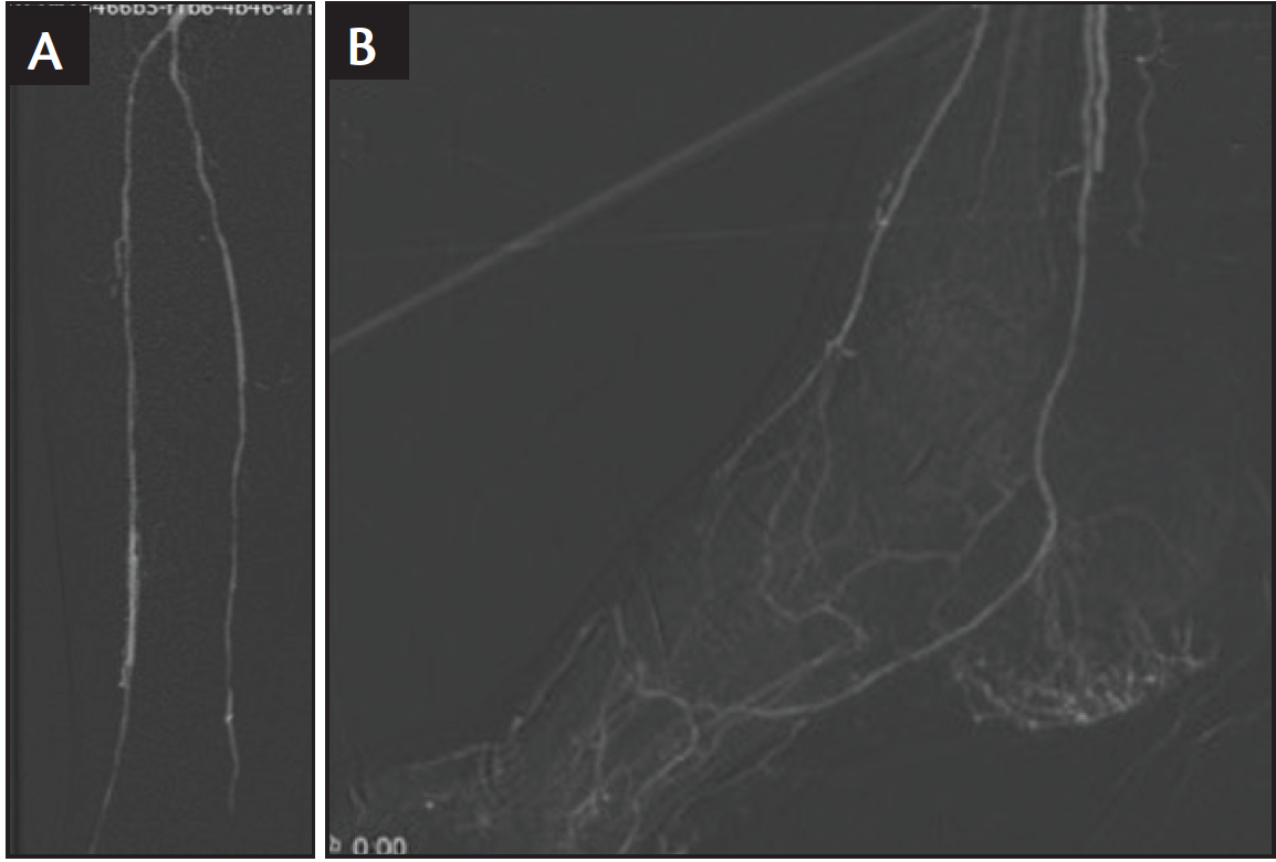 CO2 Angiography in Diabetic Critical Limb Ischemia Patients ...