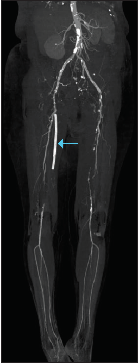 CT Reconstruction in Critical Limb Ischemia Planning - Endovascular Today