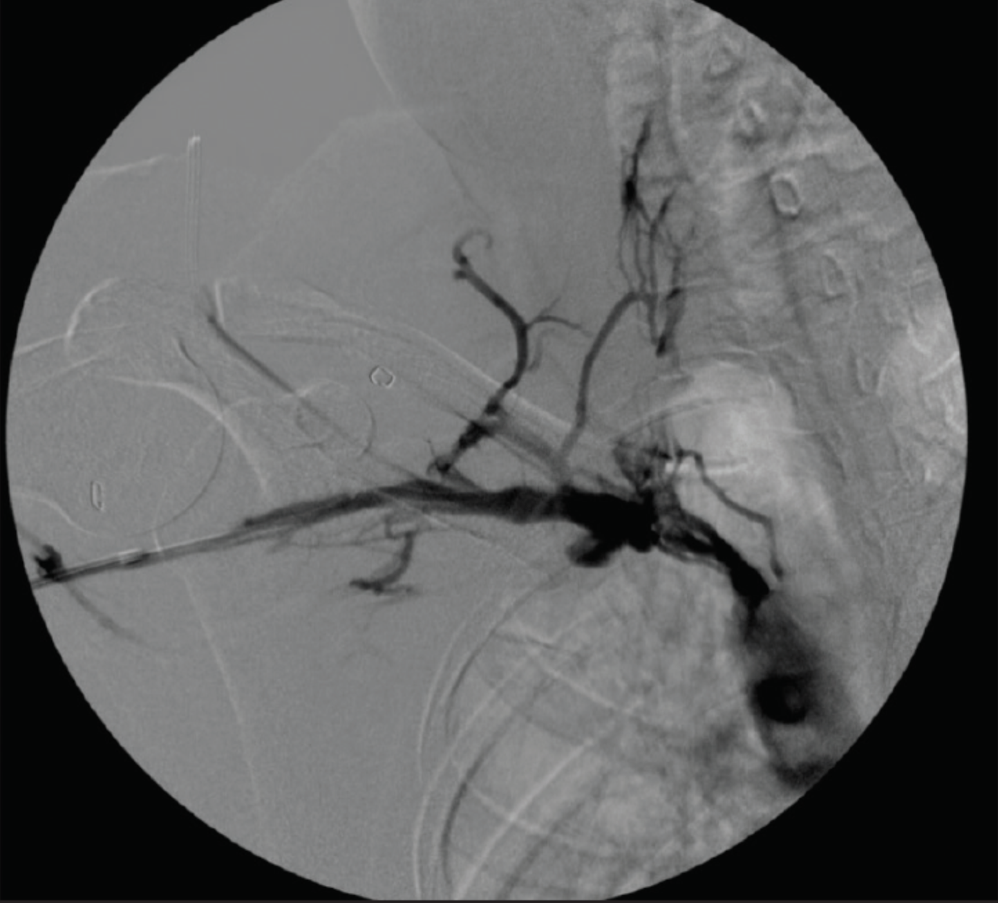 Case Report: Combining Dialysis Access Technologies to Provide a ...