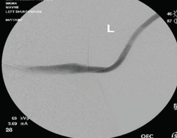 Case Report: The Versatility of the GORE® VIABAHN® Endoprosthesis ...