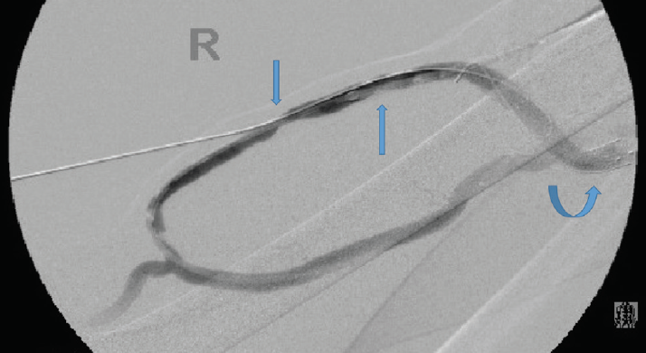 Case Report: The Versatility of the GORE® VIABAHN® Endoprosthesis ...