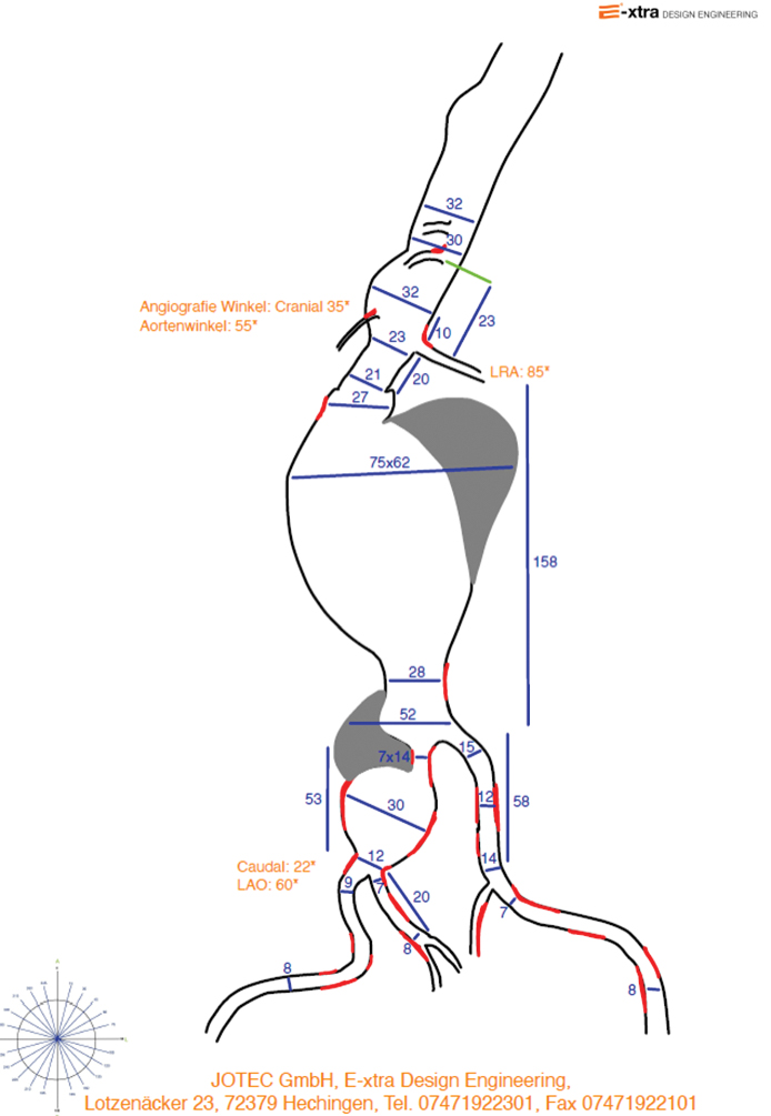 The Imperative of Preserving the Internal Iliac Artery: A Paradigm ...