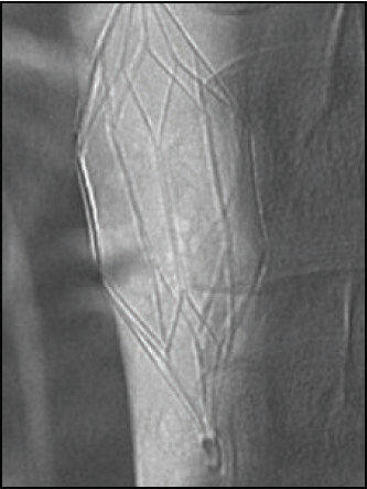 The Indigo System and CAT8 - Endovascular Today