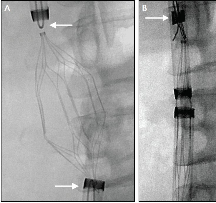 Current IVC Filter Retrieval Techniques - Endovascular Today