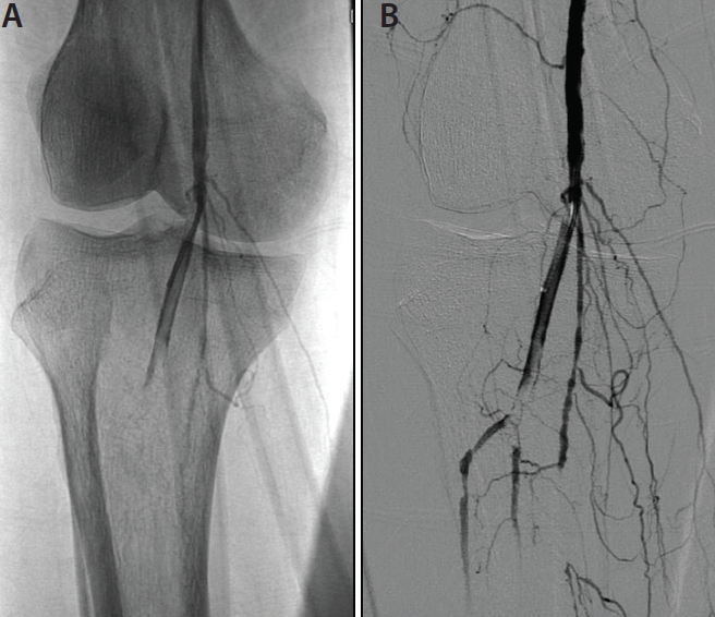 Indigo® System for Thromboembolic Disease - Endovascular Today