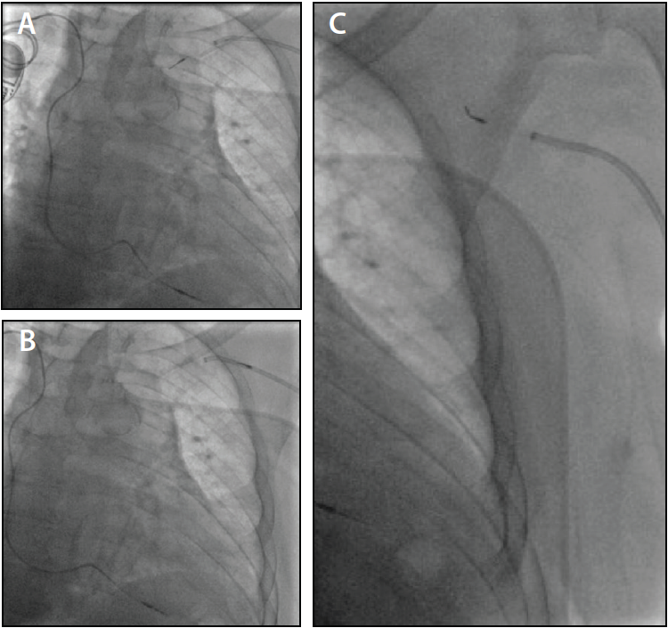 The Indigo System and CAT8 - Endovascular Today