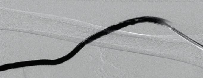 Indigo® System for Thromboembolic Disease - Endovascular Today